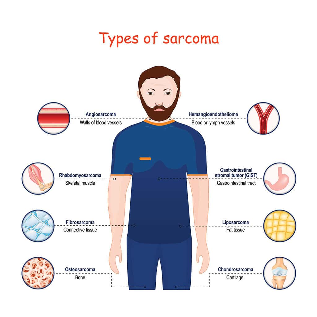 All You Need to Know About Sarcoma - CK Birla Hospital