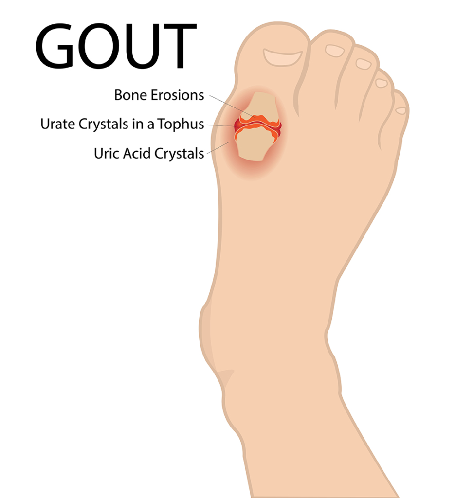Gout - Causes, Signs, Diagnosis & Treatment | CK Birla Hospital