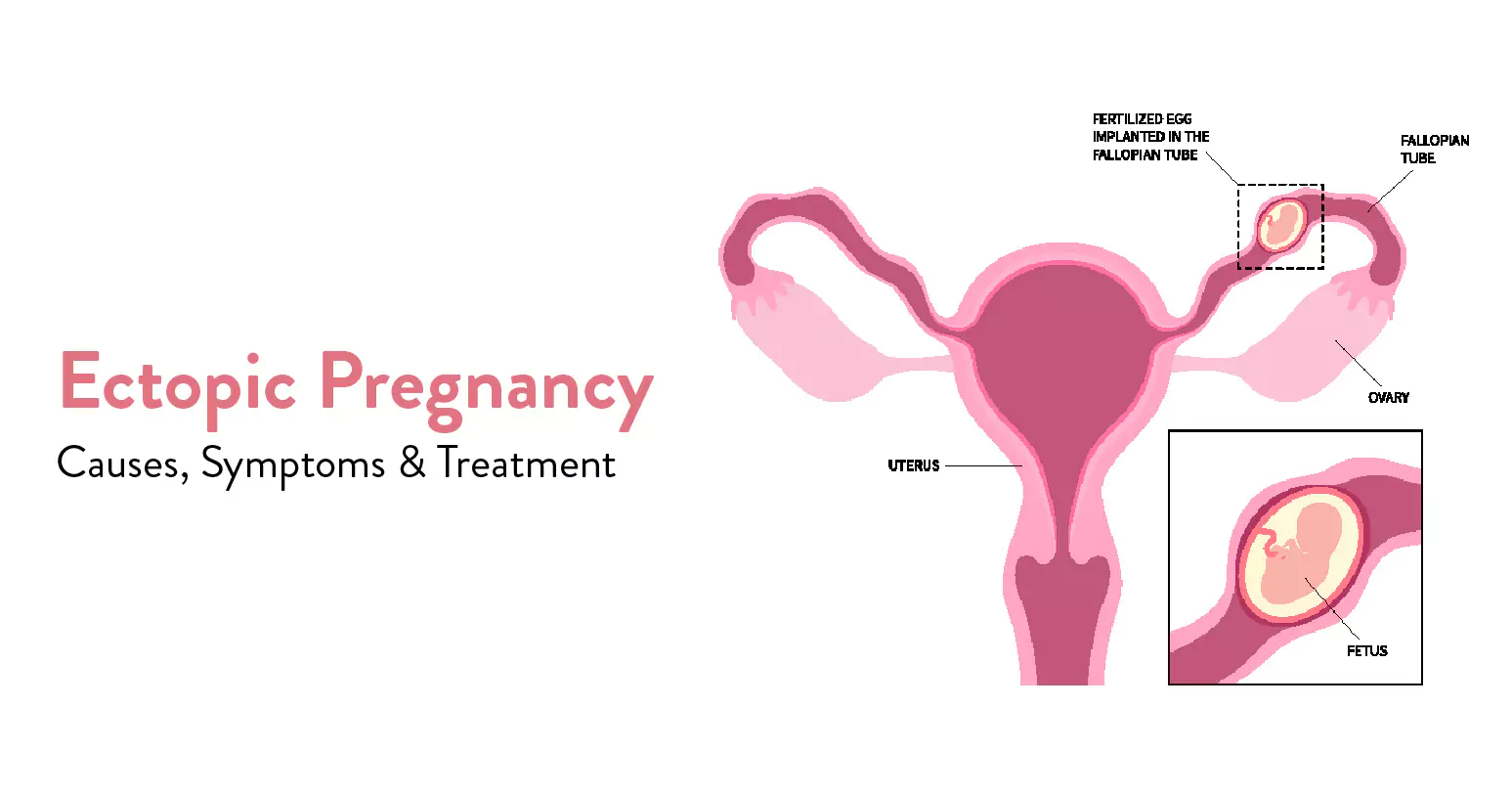 Causes Of Ectopic Pregnancy